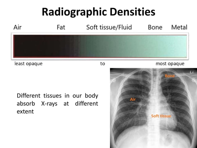Chest X-rays for Undergraduates | PPTX