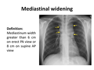 Chest X-rays for Undergraduates | PPTX