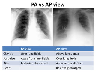 Chest X-rays for Undergraduates | PPT
