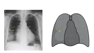 Chest X-Rays | PPT