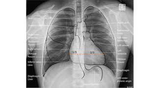 Chest X-Rays | PPT