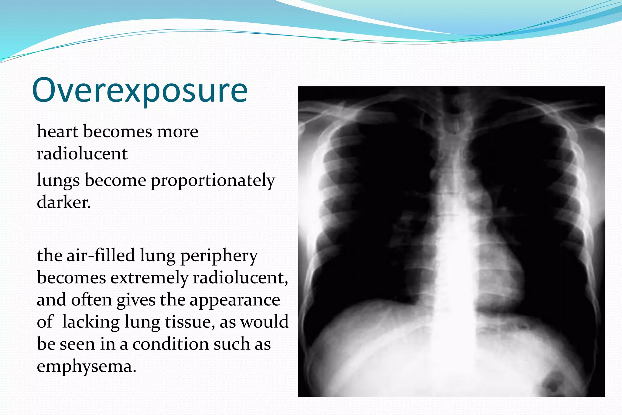 Chest x ray | PPTX