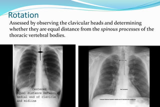 Chest x ray | PPTX