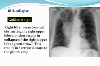 Chest x ray | PPTX