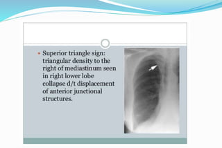 Chest x ray | PPTX