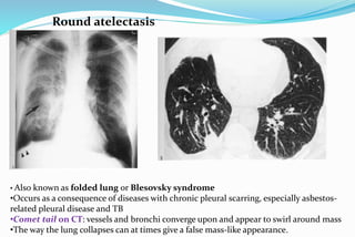 Chest x ray | PPTX
