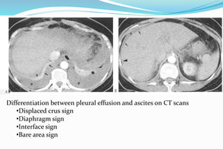 Chest x ray | PPTX