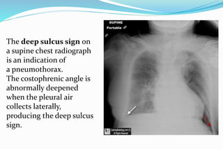 Chest x ray | PPTX