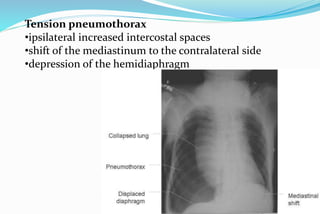 Chest x ray | PPTX