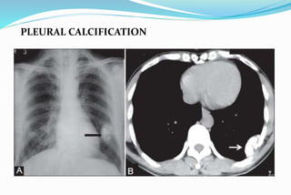 Chest x ray | PPTX