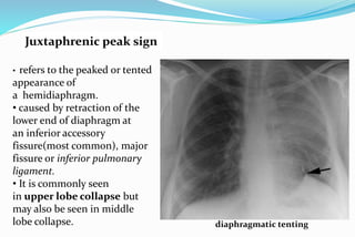 Chest x ray | PPT