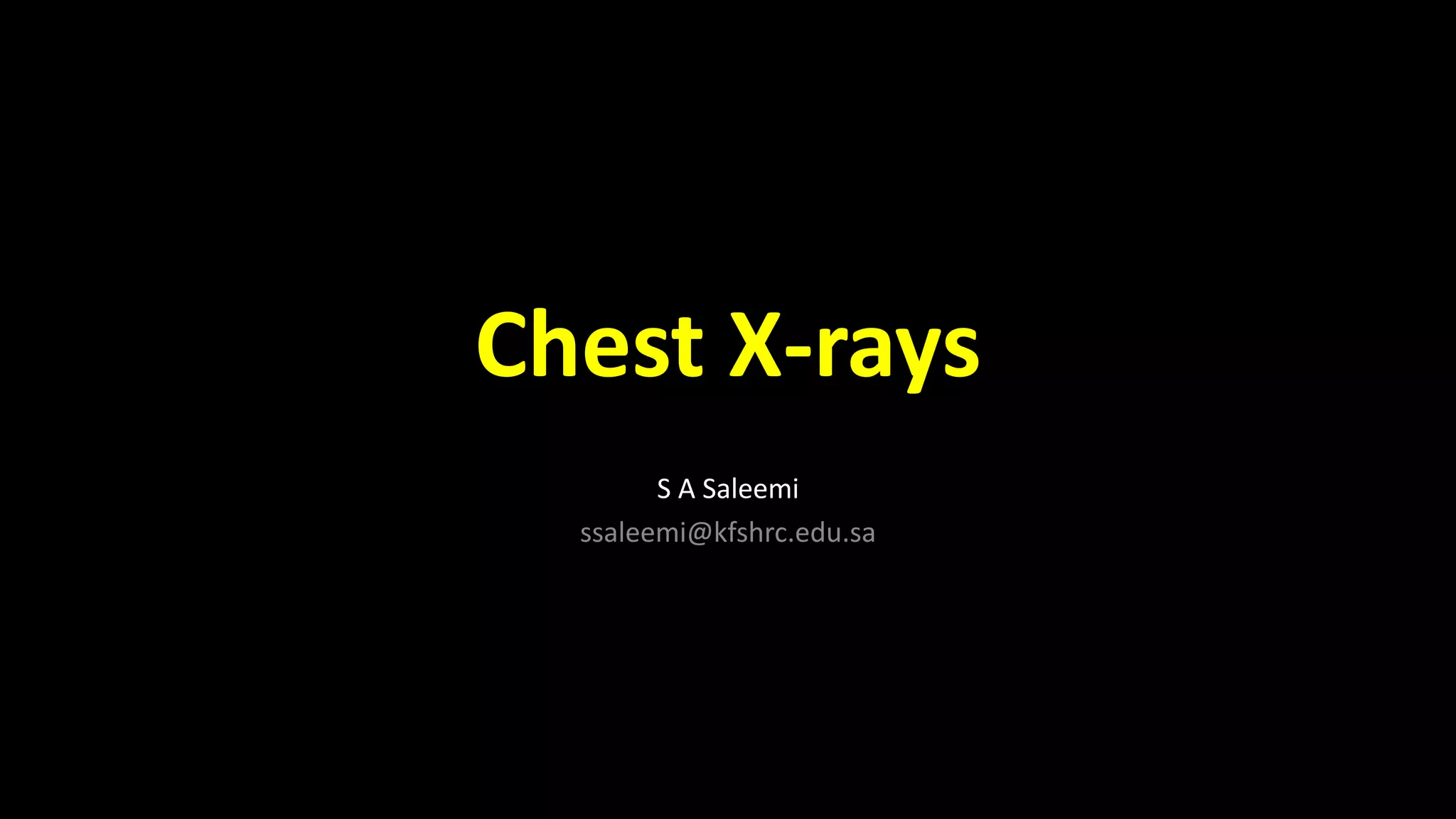 Chest X-ray Basics and Interpretation | PPTX