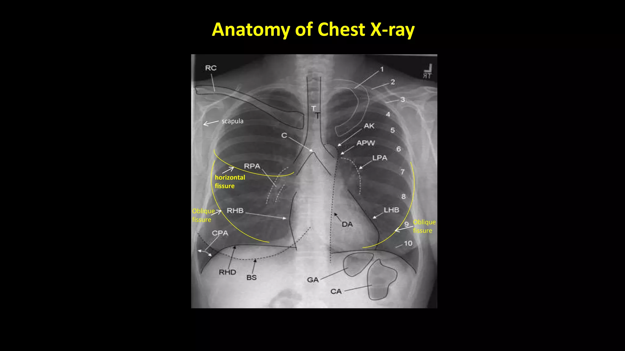 Chest X-ray Basics and Interpretation | PPTX