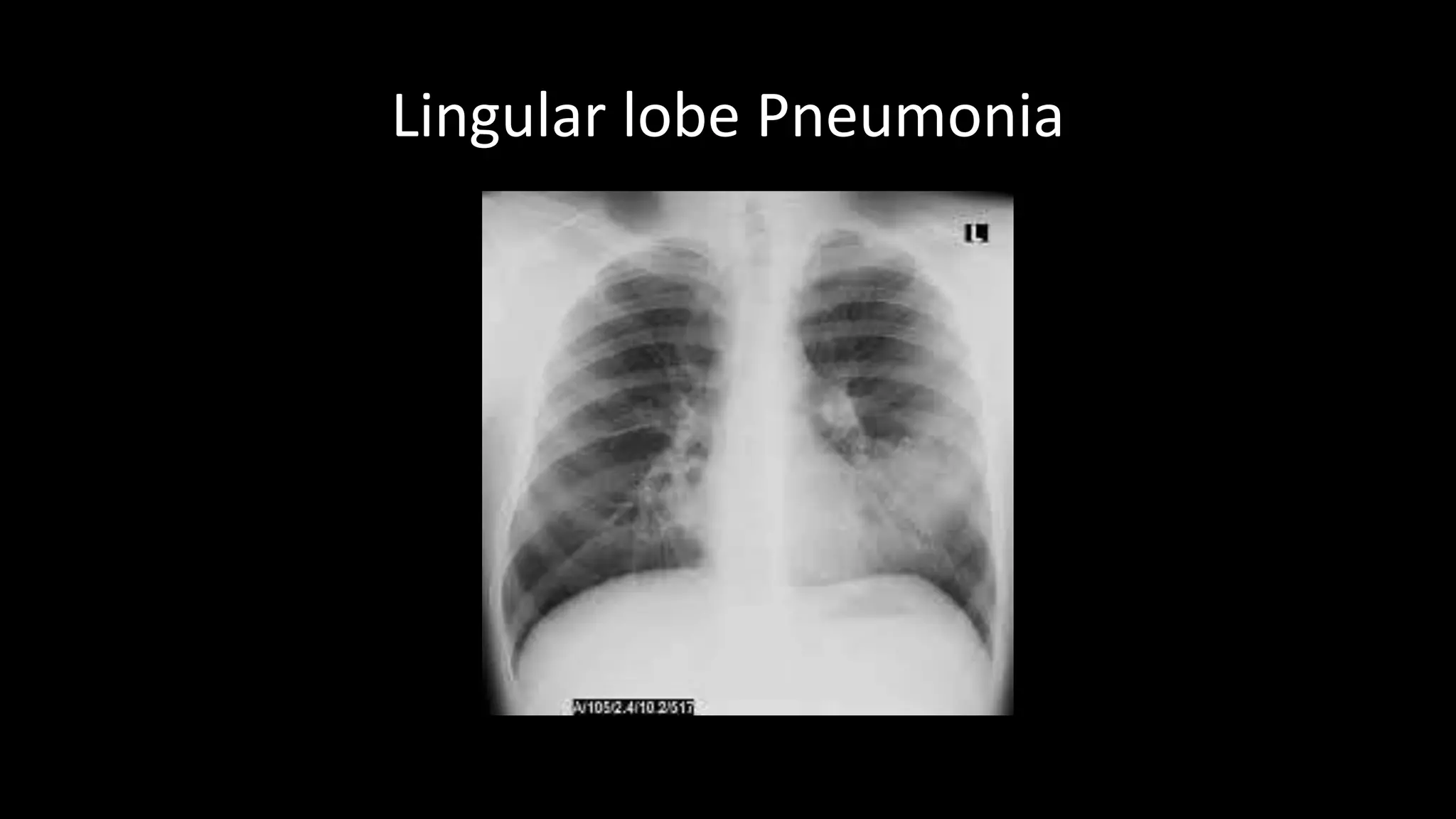 Chest X-ray Basics and Interpretation | PPTX