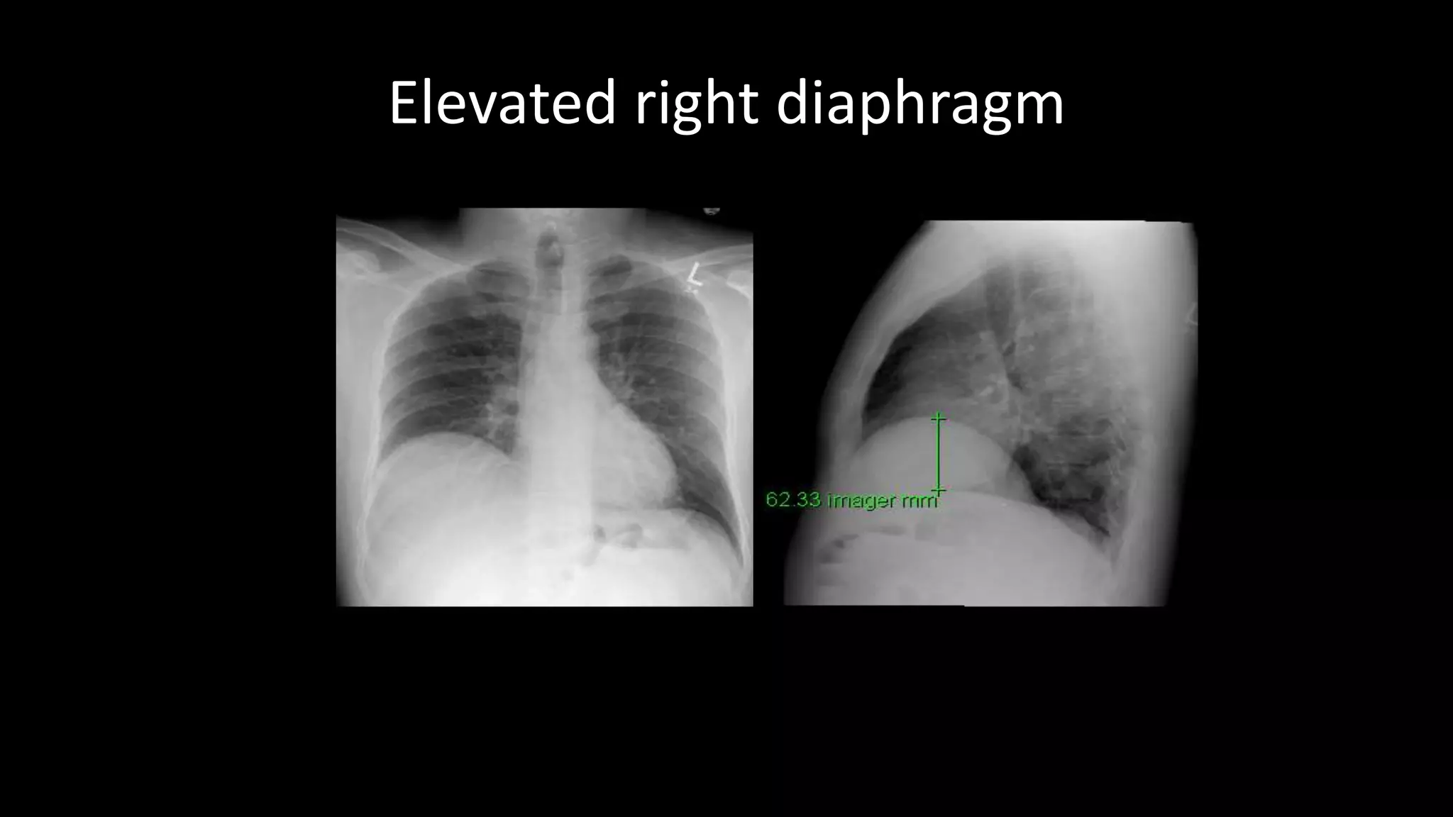 Chest X-ray Basics and Interpretation | PPTX