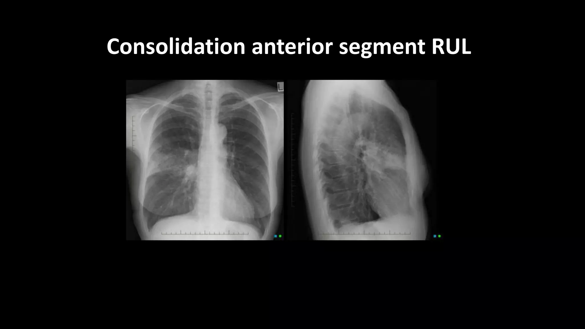 Chest X-ray Basics and Interpretation | PPTX