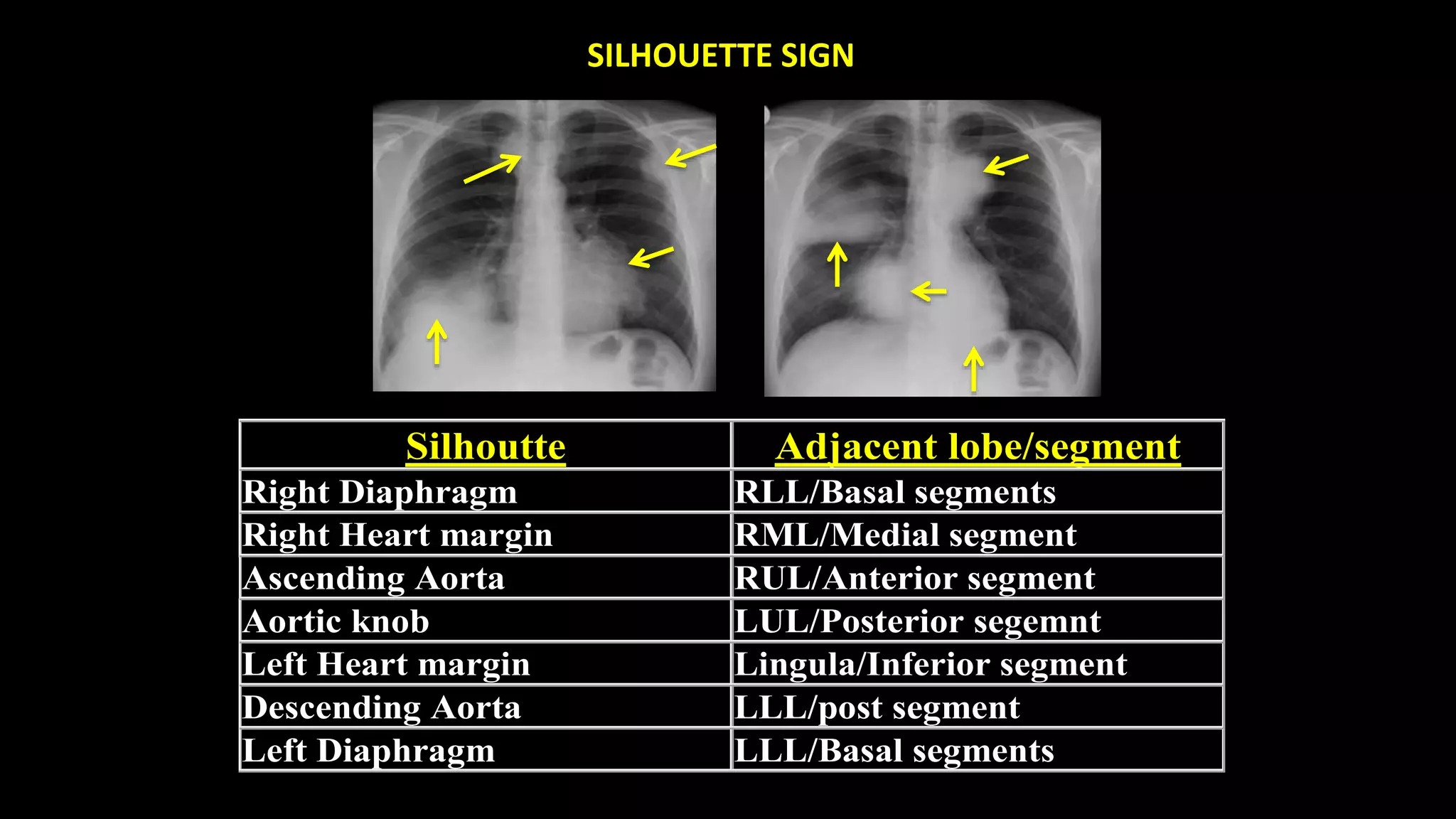 Chest X-ray Basics and Interpretation | PPTX