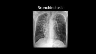 Chest X-ray Basics and Interpretation | PPTX
