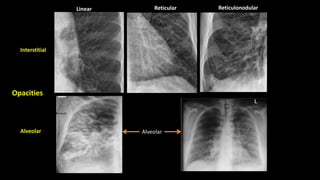 Chest X-ray Basics and Interpretation | PPTX