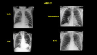 Chest X-ray Basics and Interpretation | PPTX
