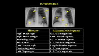 Chest X-ray Basics and Interpretation | PPTX