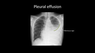 Chest X-ray Basics and Interpretation | PPTX