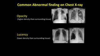 Chest X-ray Basics and Interpretation | PPT