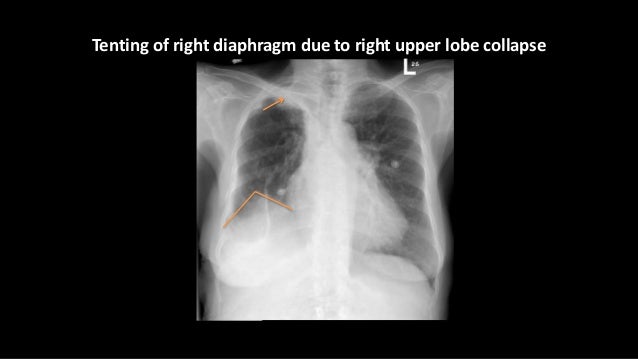 Chest X-ray Basics and Interpretation