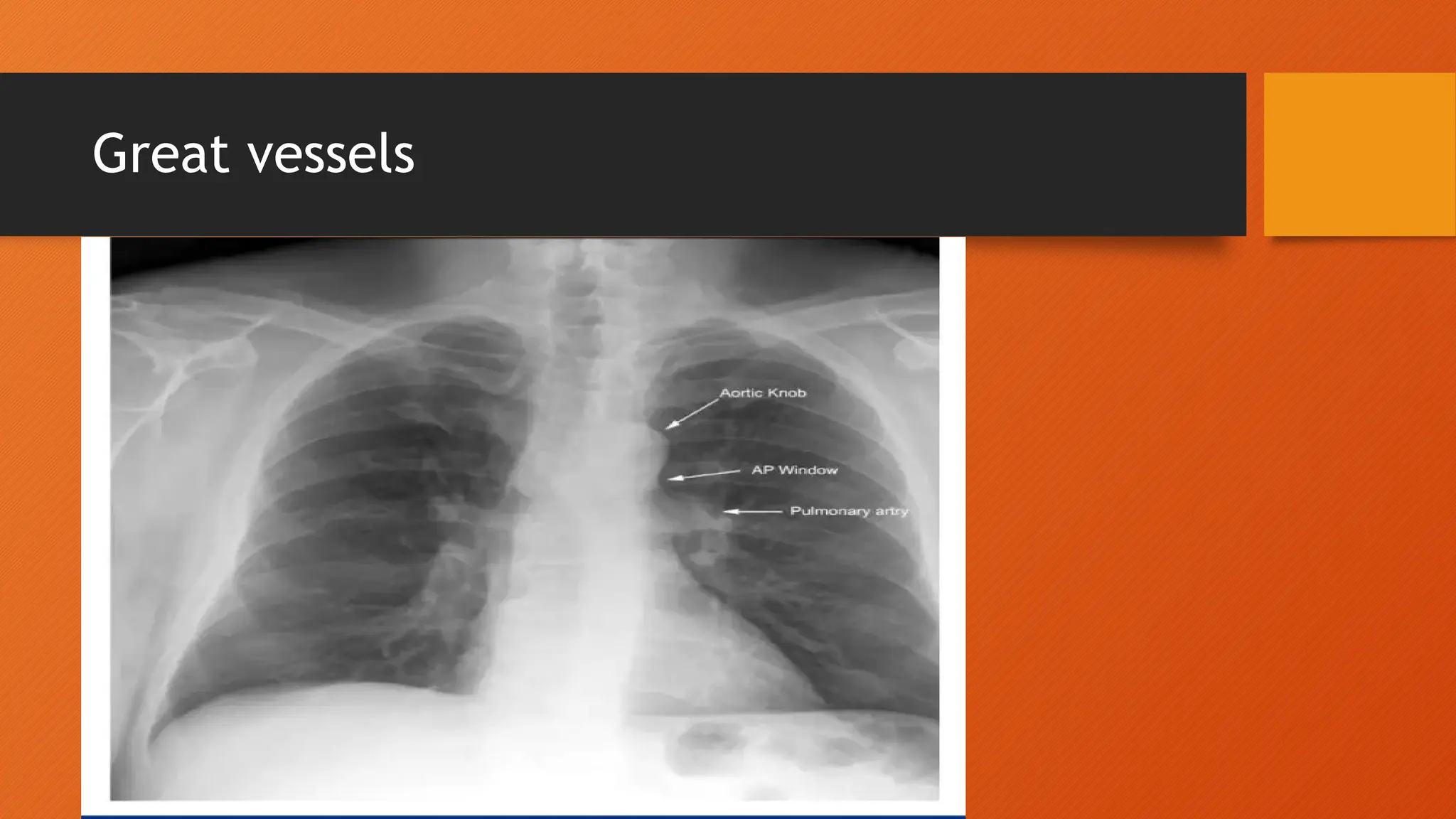 Chest X-Rays.pptx.. Mbbs final year ppts | PPTX