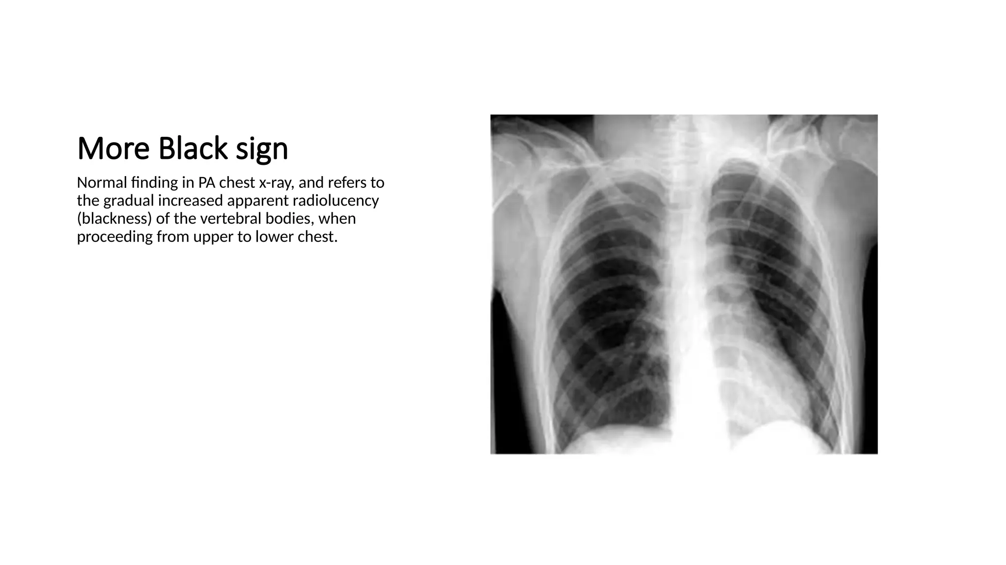 Chest x-ray INTERPRETATION AND signs.pptx