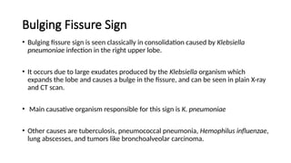 Chest x-ray INTERPRETATION AND signs.pptx