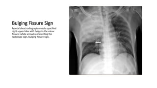 Chest x-ray INTERPRETATION AND signs.pptx