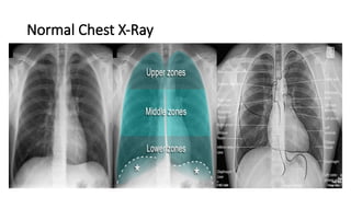 Chest x-ray INTERPRETATION AND signs.pptx