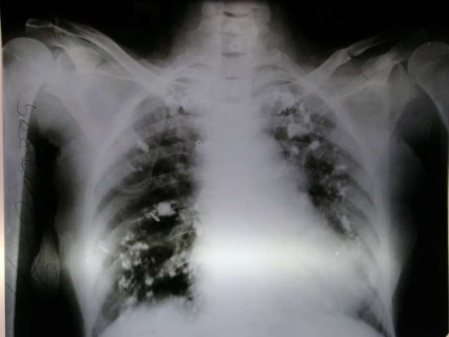 X-Ray: Calcification in CXR | PPTX