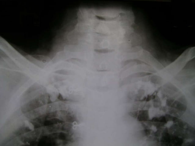 X-Ray: Calcification in CXR | PPTX