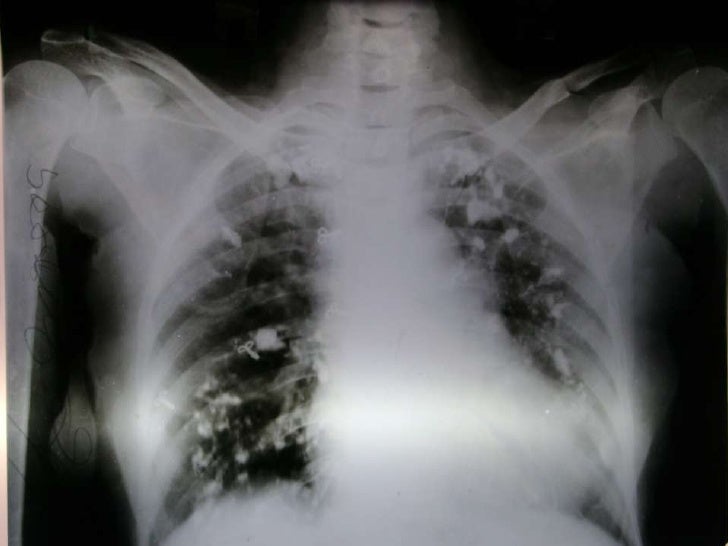 X-Ray: Calcification in CXR