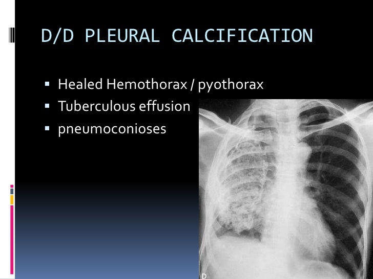 X-Ray: Calcification in CXR