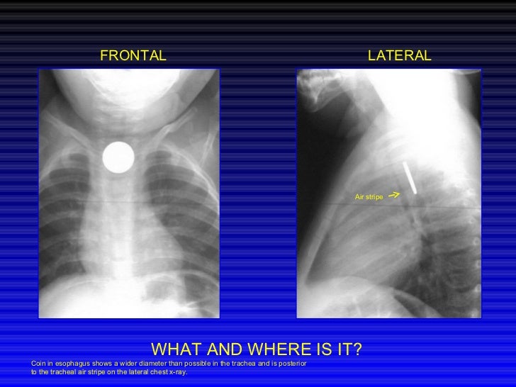 Chest xray