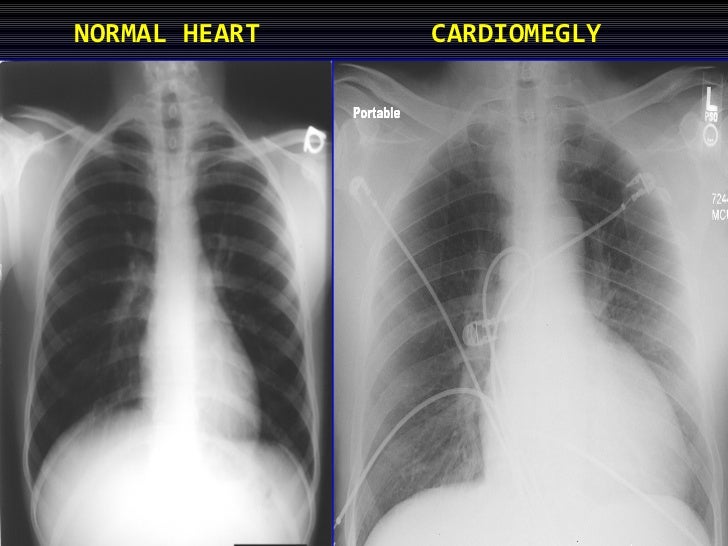 Chest xray