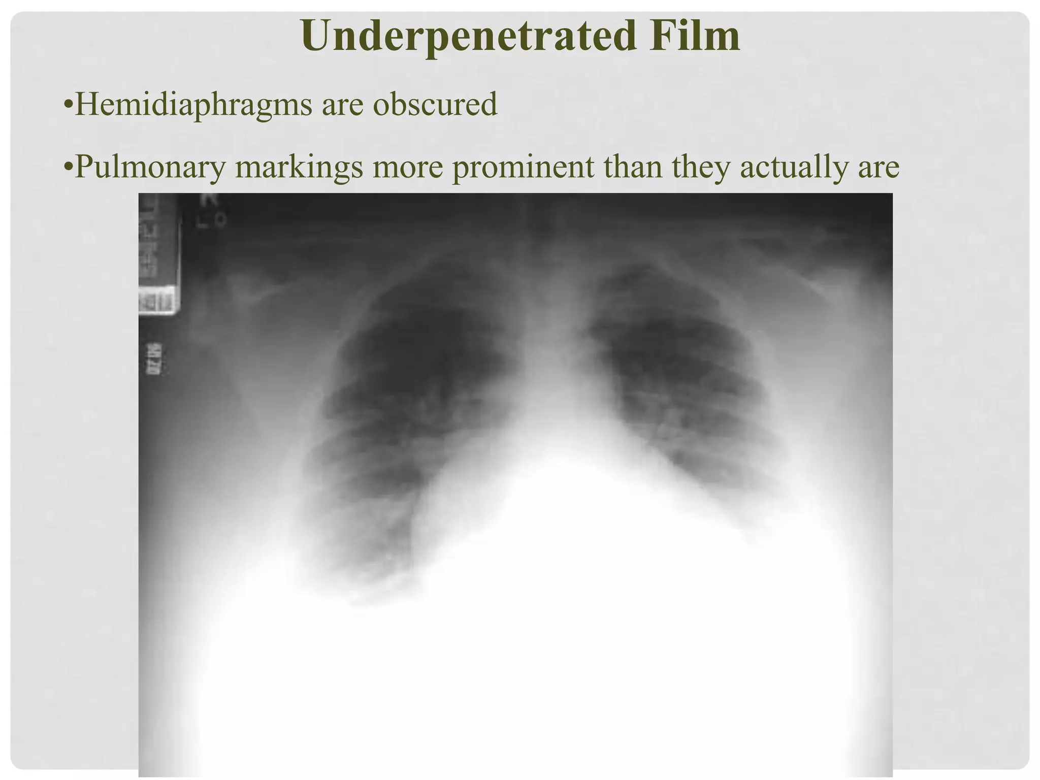 Normal Chest X-ray | PPTX