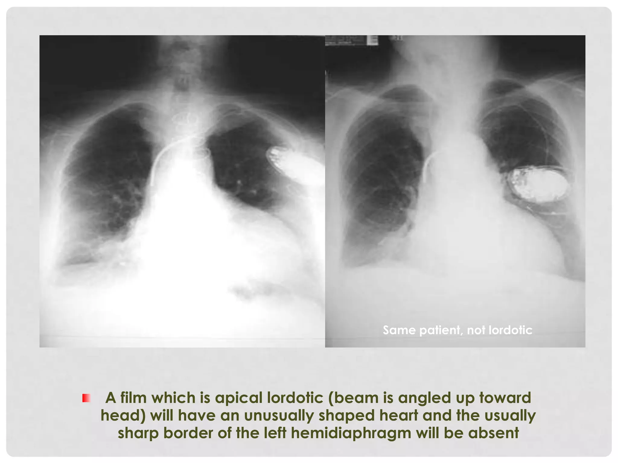 Normal Chest X-ray | PPTX