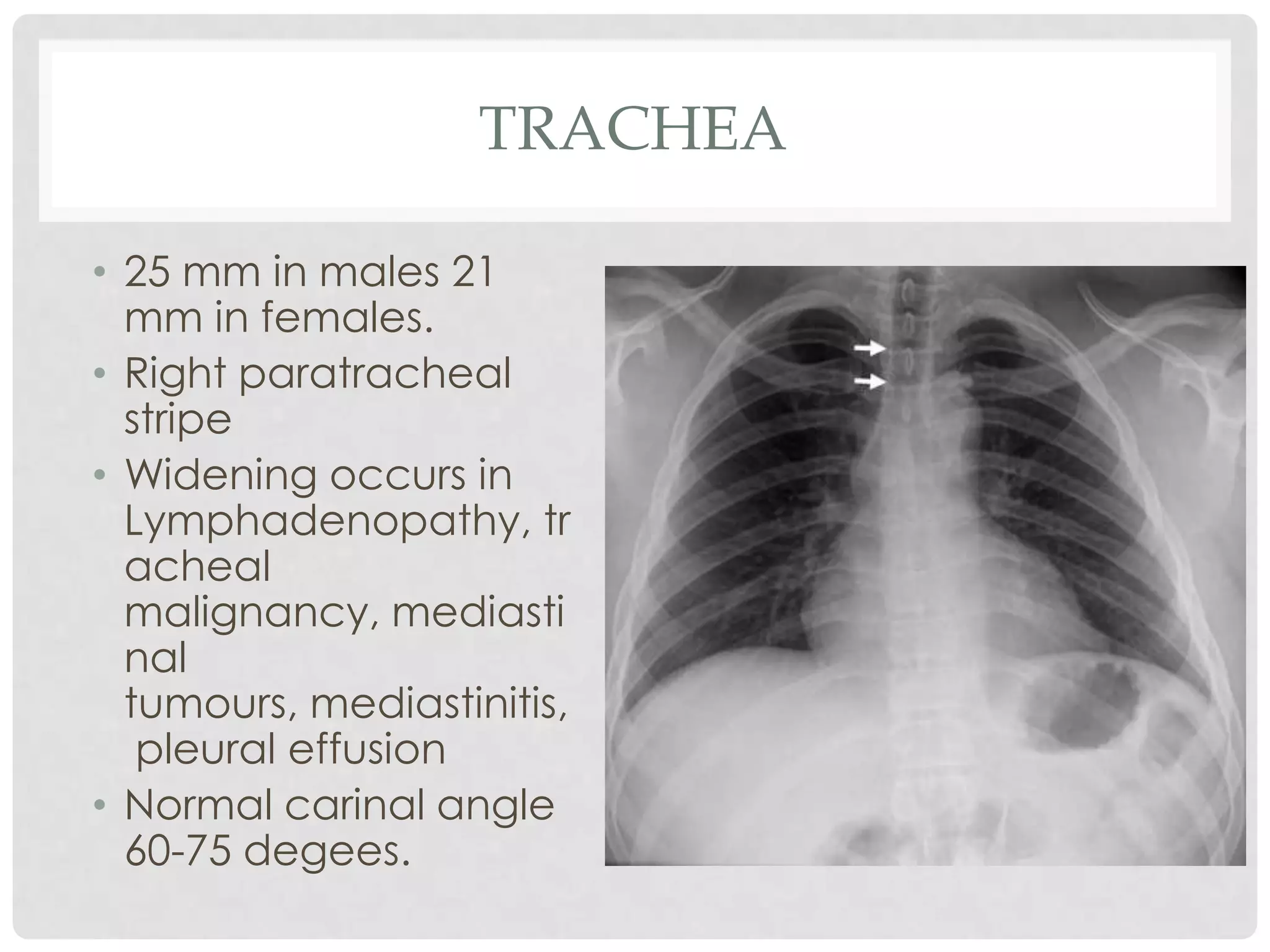 Normal Chest X-ray | PPTX