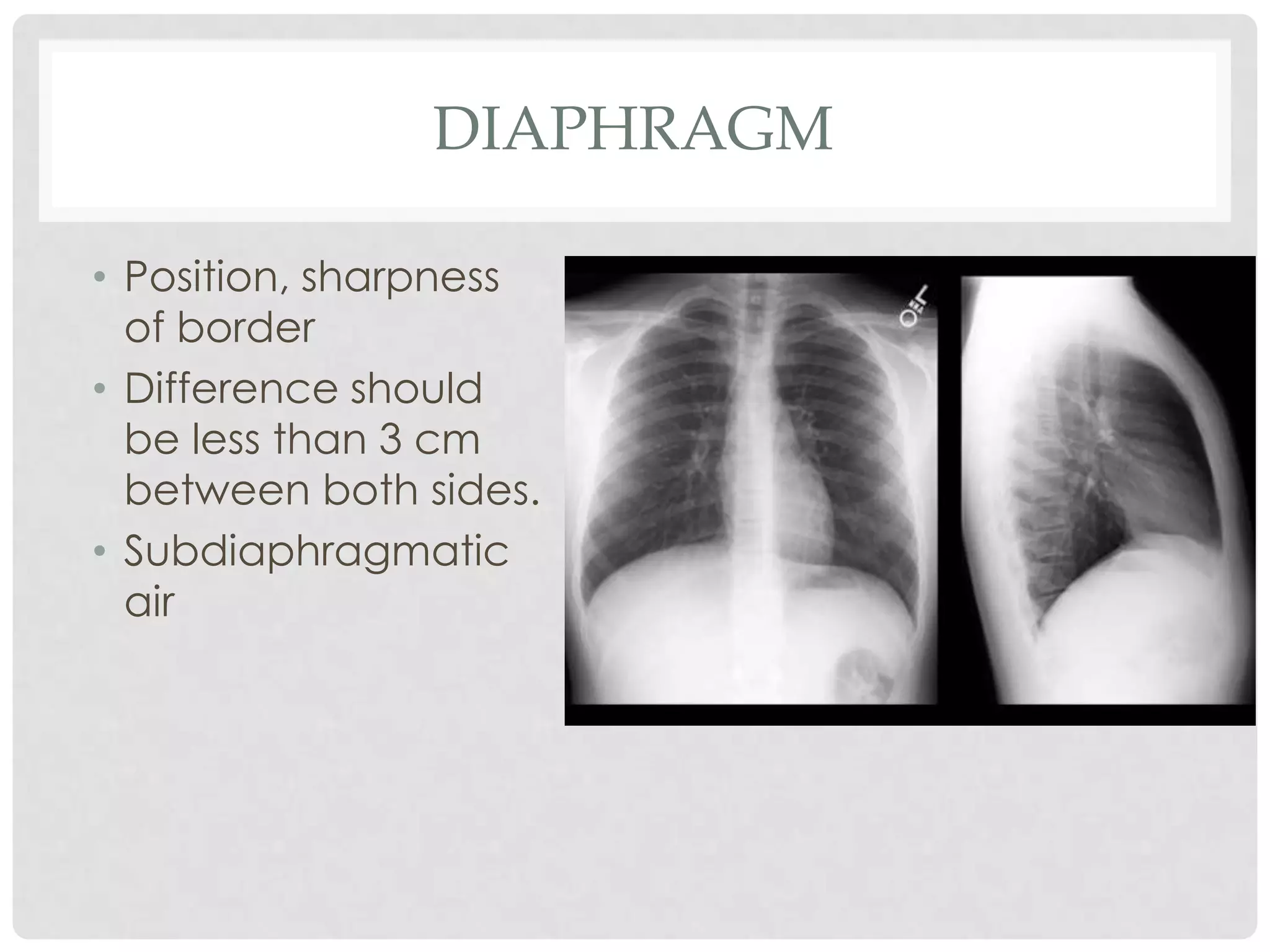 Normal Chest X-ray | PPTX