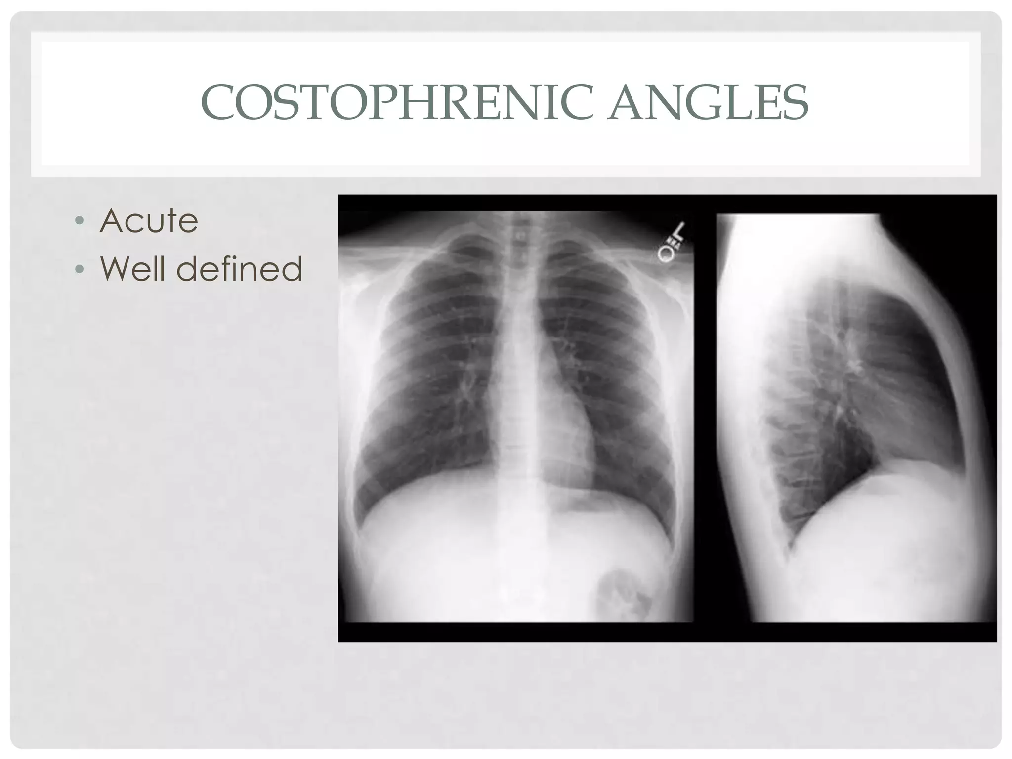 Normal Chest X-ray | PPTX