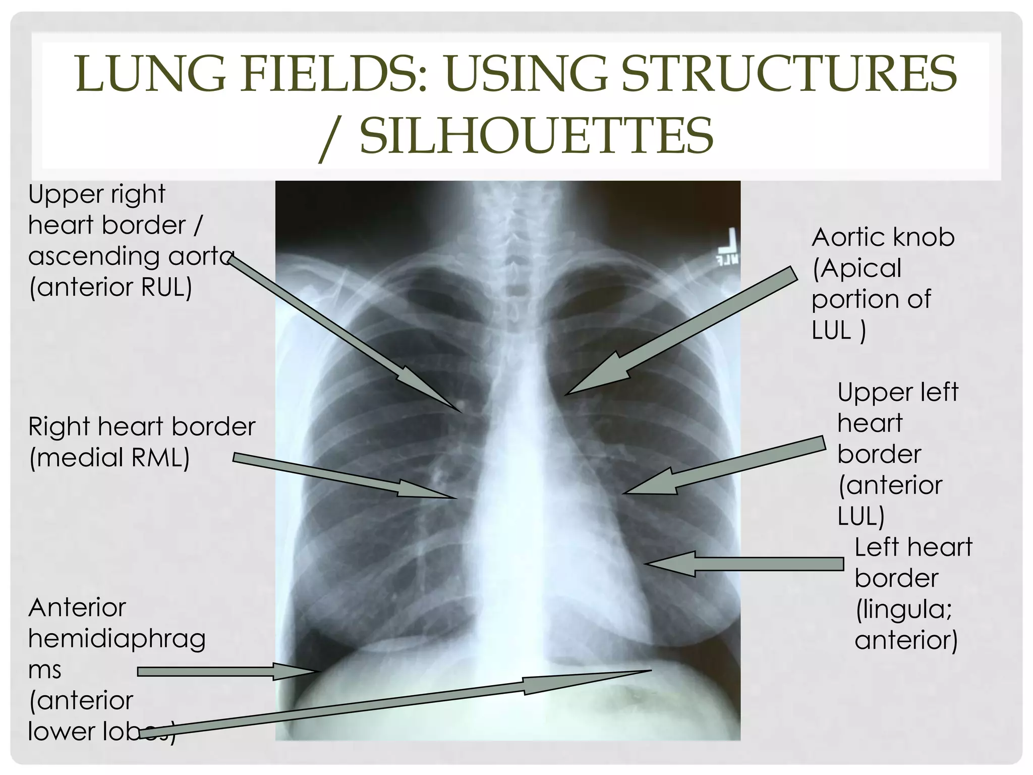 Normal Chest X-ray | PPTX