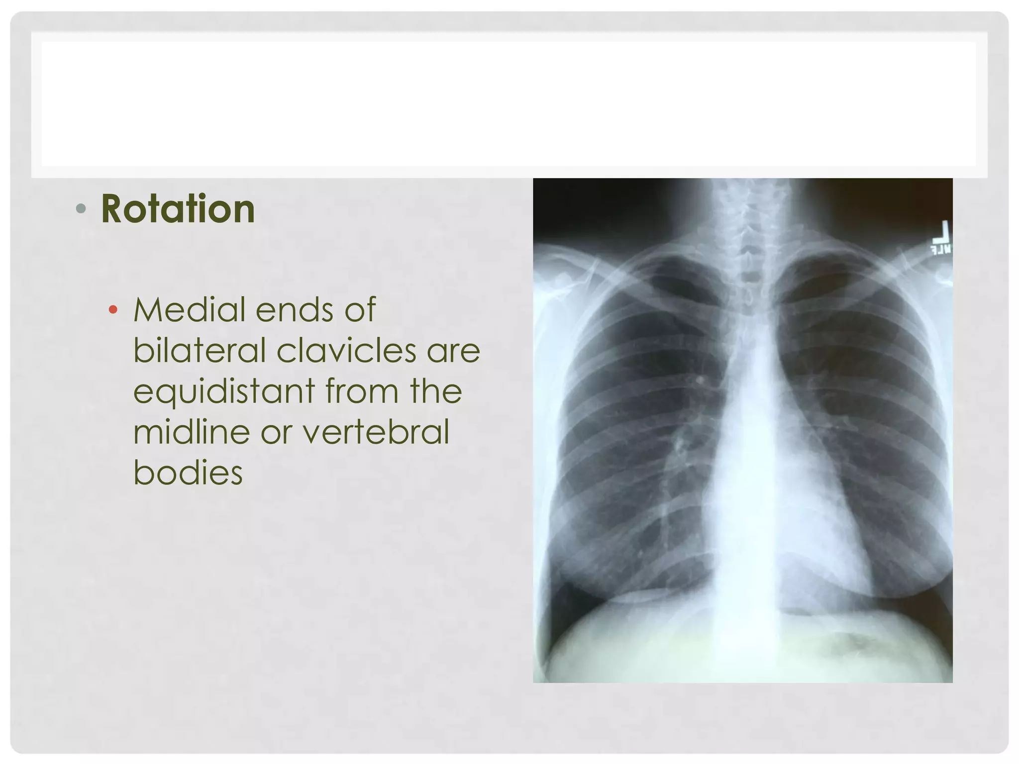 Normal Chest X-ray | PPTX