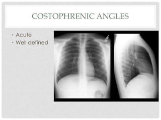 Normal Chest X-ray | PPTX | Lung and Respiratory Health | Diseases and ...
