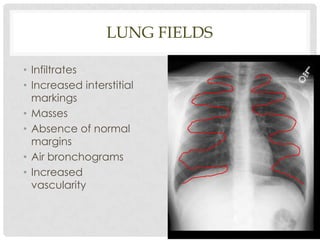 Normal Chest X-ray | PPTX