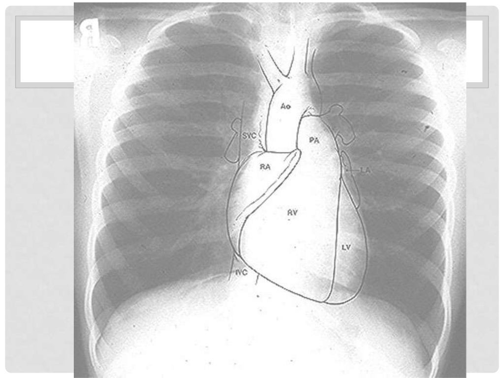 Normal Chest X-ray