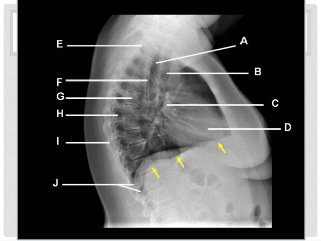 Normal Chest X Ray Female